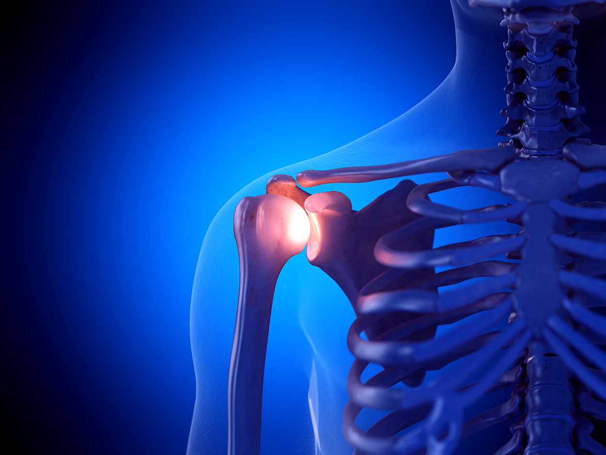 Shoulder Implants - Healthtrust Education
